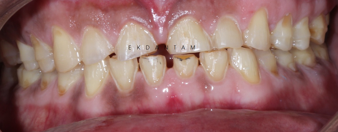 Full Mouth Rehab With Emax Veneers & Onlays - Ekdantam